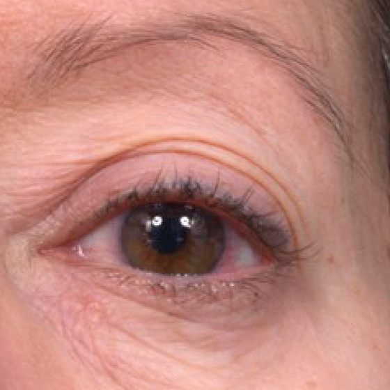 Cosmetic Eye Treatment - Cynosure Canada EN