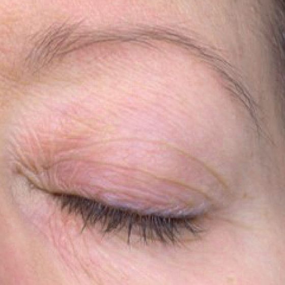 Cosmetic Eye Treatment - Cynosure Canada EN